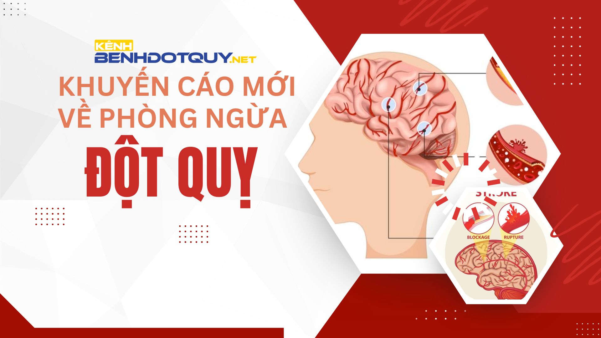 10 thông điệp quan trọng trong khuyến cáo mới về phòng ngừa đột quỵ ...