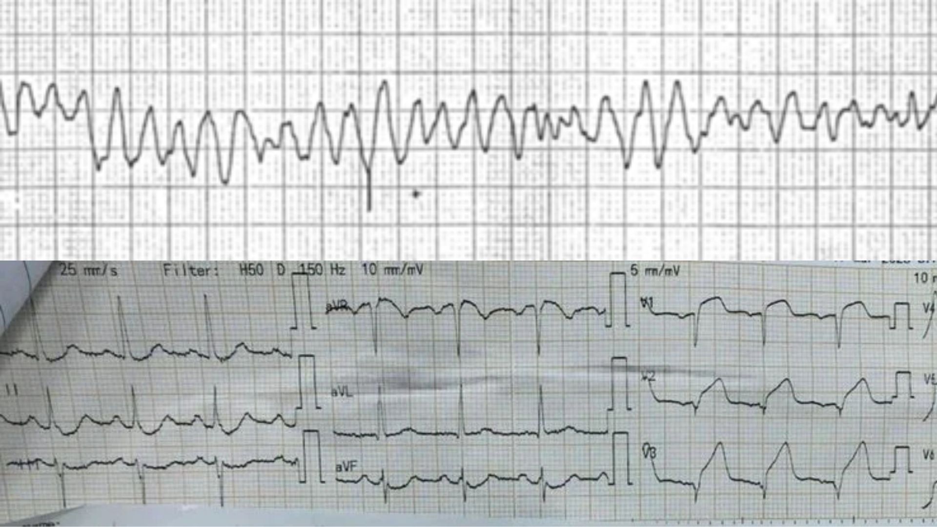 BV Nhân dân 115 cấp cứu thành công ca rung thất do nhồi máu cơ tim cấp ...